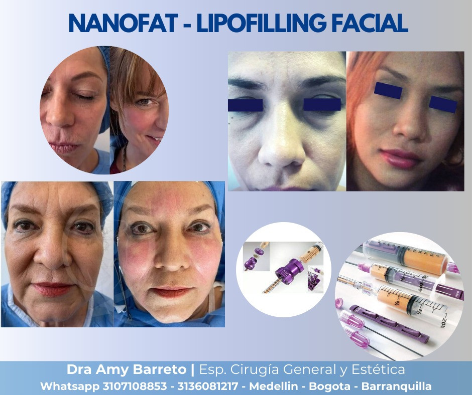 Nanofat: Rejuvenecimiento y Mejora de la Piel - Precio 2024