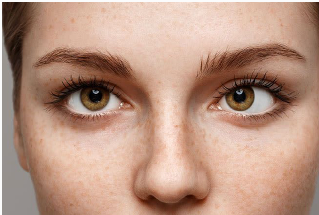 Microtropia: The Subtle Misalignment You Might Be Overlooking ...