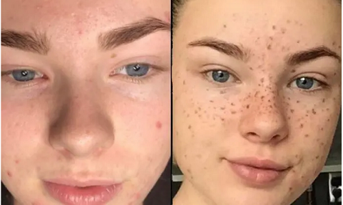 PERMANENT FRECKLES TATTOO | website-1