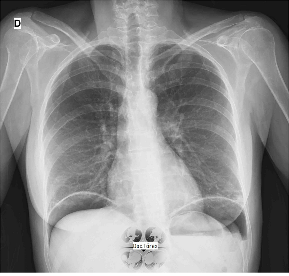 Neumoperitoneo: Radiografía.