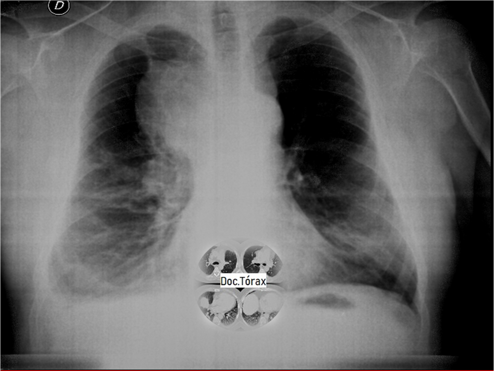 Signo de lesión extrapulmonar.