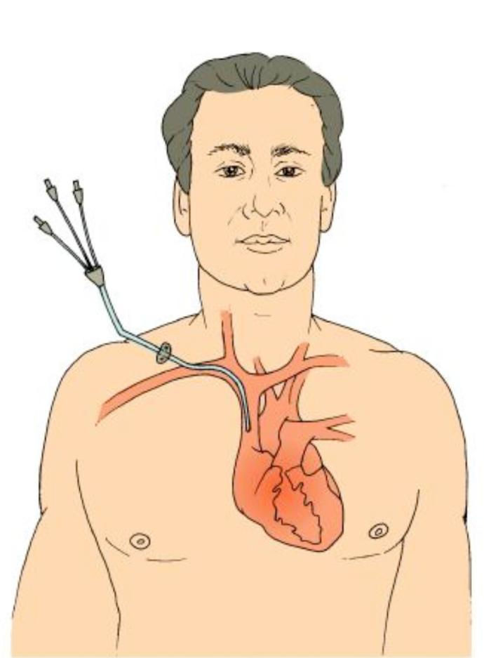Minder vaak wisselen van CVK, bespaart 45 minuten en het milieu ...