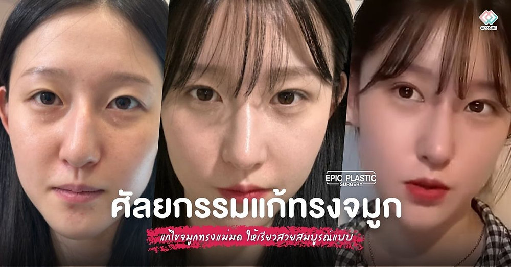 รีวิว: ศัลยกรรมแก้ทรงจมูก | โรงพยาบาลศัลยกรรมอีพิค (Epic Plastic Surgery)
