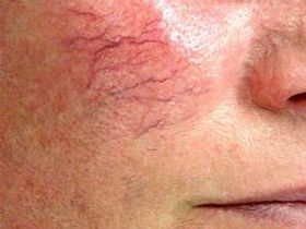 telangiectasia forehead
