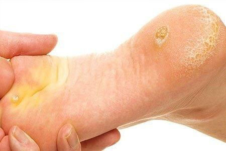 Veruccas and Warts: Causes, Symptoms and Treatment
