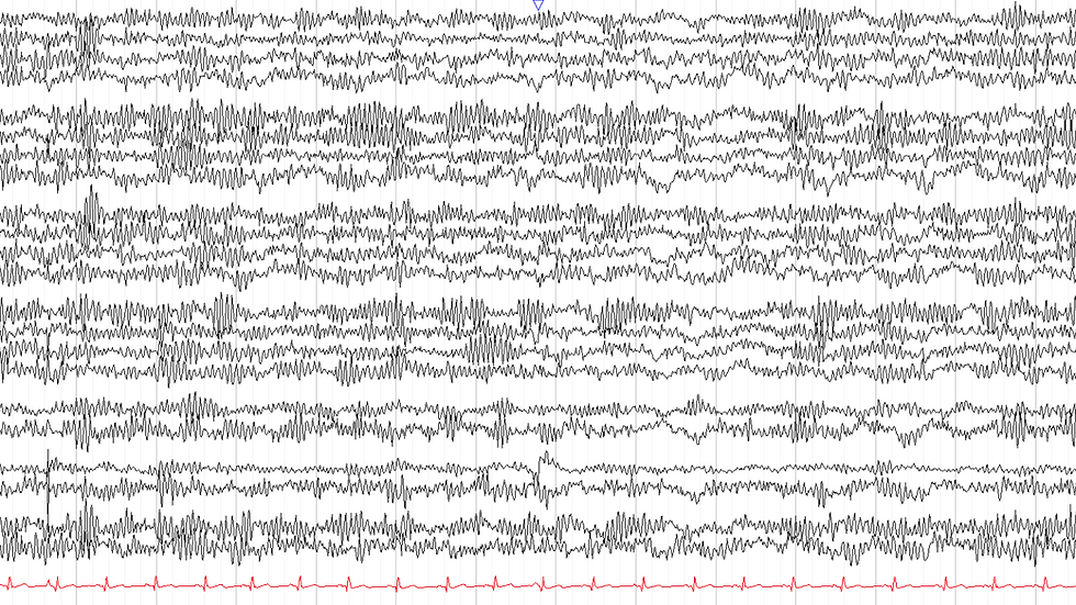 EEG and Encephalopathy