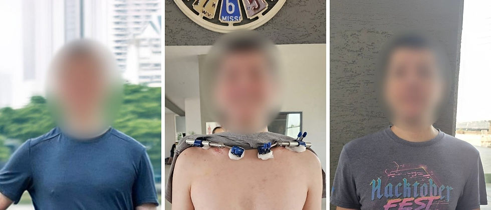 Clavicle Lengthening Surgery: Everything You Need to Know About ...