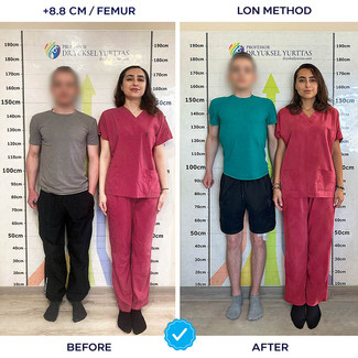 Limb Lengthening Surgery in Turkey | Prof. Dr. Yuksel Yurttas