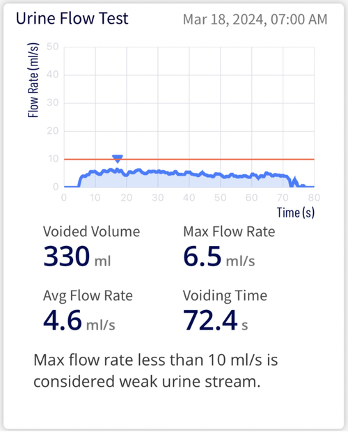 Uroflowmetry: A Quick Test to Measure Urine Flow