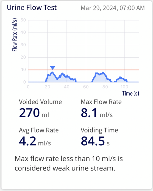 Uroflowmetry: A Quick Test to Measure Urine Flow