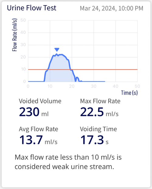 Uroflowmetry: A Quick Test to Measure Urine Flow