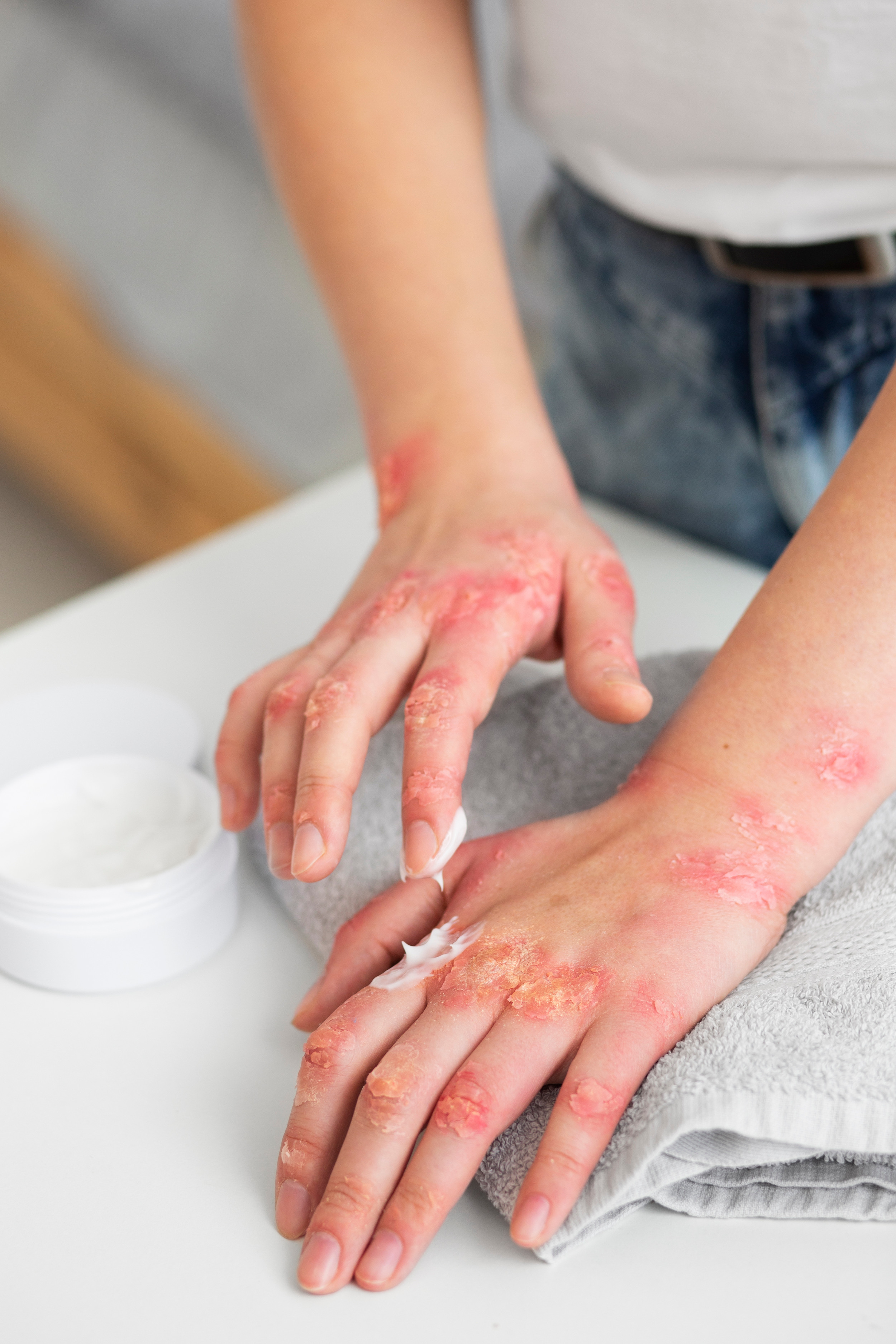 Effective Scabies Treatments: Relief from the Itch and Discomfort
