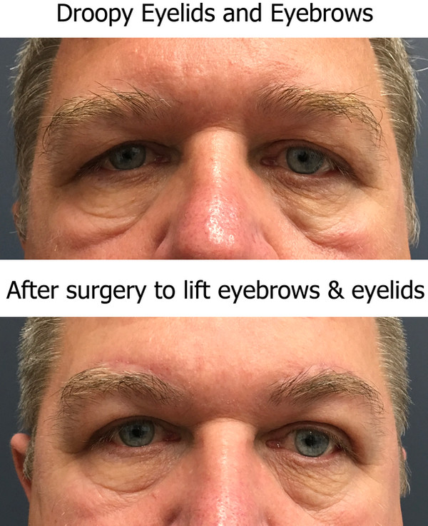 Eyelid surgery | Elizabeth Chiang Oculoplastics