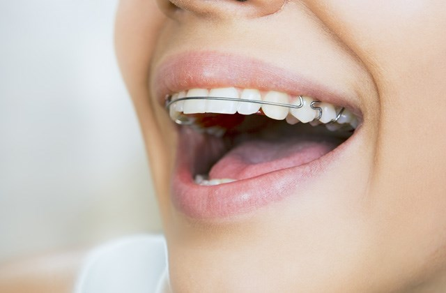 APARELHO MÓVEL: a importância do uso após o tratamento ortodôntico