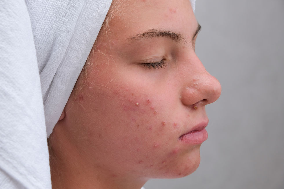 Stieva-A Cream Singapore: The Double Duty Cream for Acne and Wrinkles ...