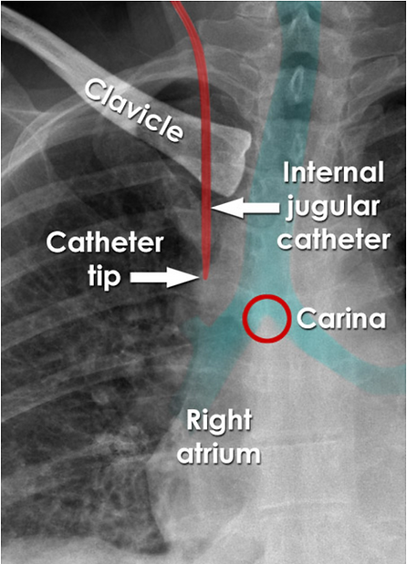 Confirming CVC Position | Icuquickguide