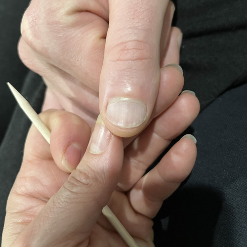 Fingernail Clipping | Womble's Foot Care