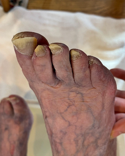 #2. Advanced Nail Care Package with Callus and/or Corn Reduction ...