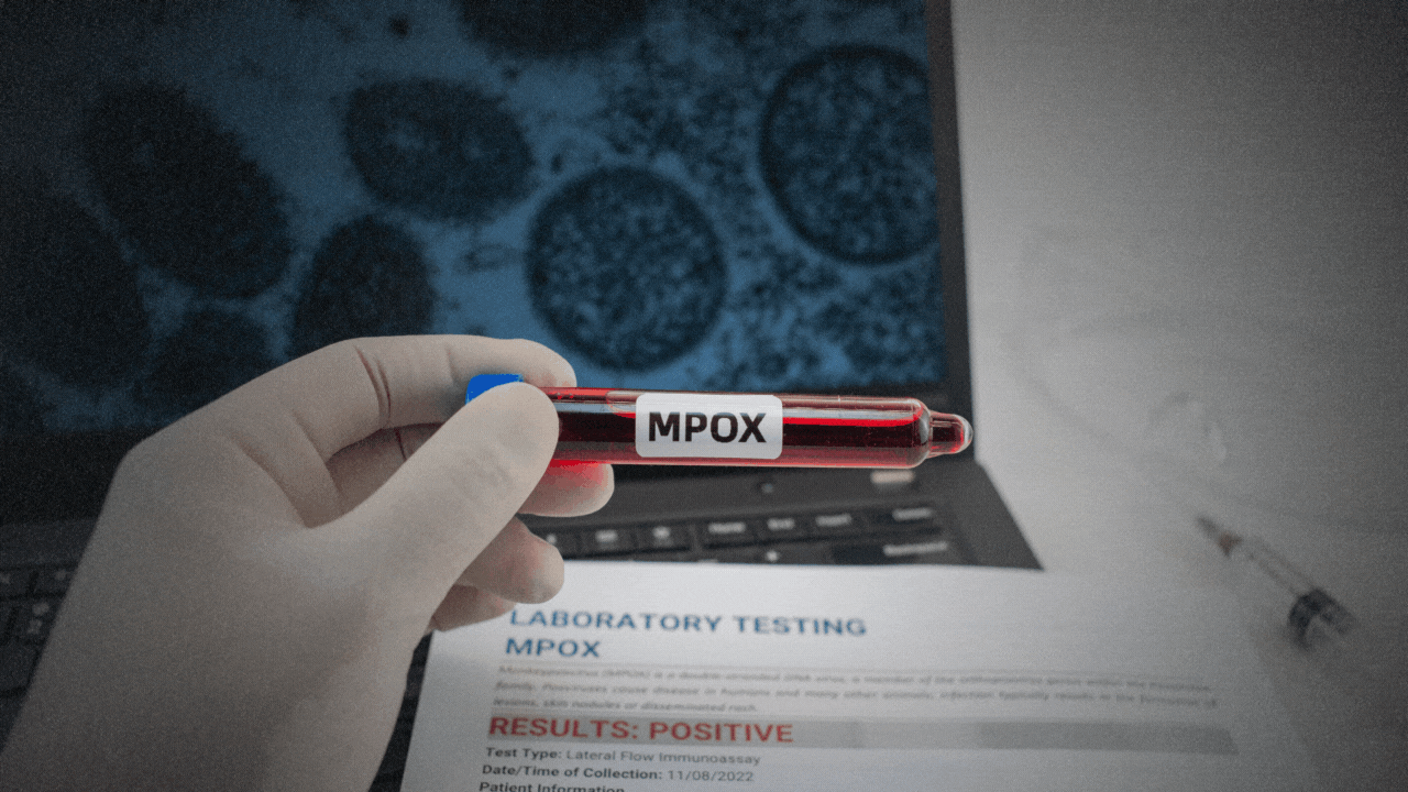 India 'investigating' suspected mpox case