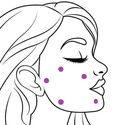 Nee Soon Clinic - Profhilo® Singapore $1000 Nett | MOH Certified Doctor