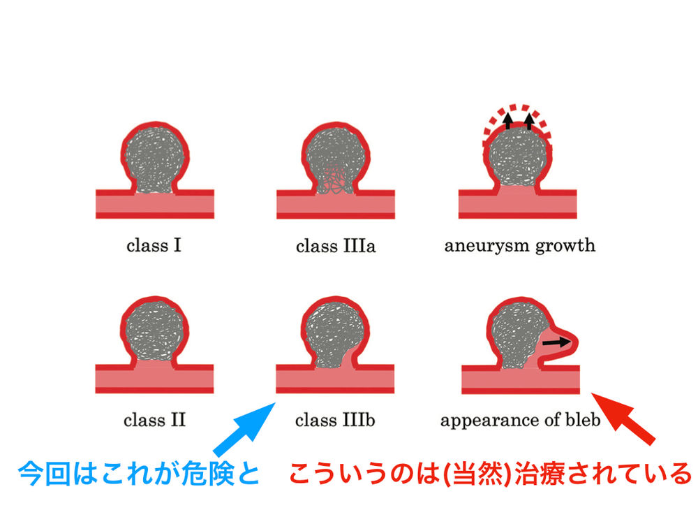関西の?血管内手術の成績2
