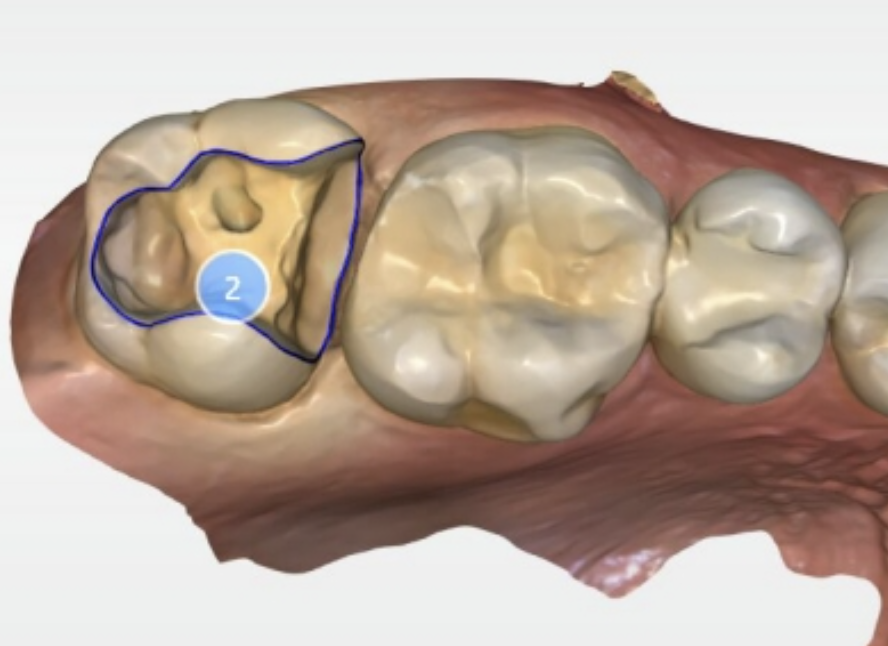 Inlays and Onlays: Minimally Invasive Solution for Heavily Restored Teeth