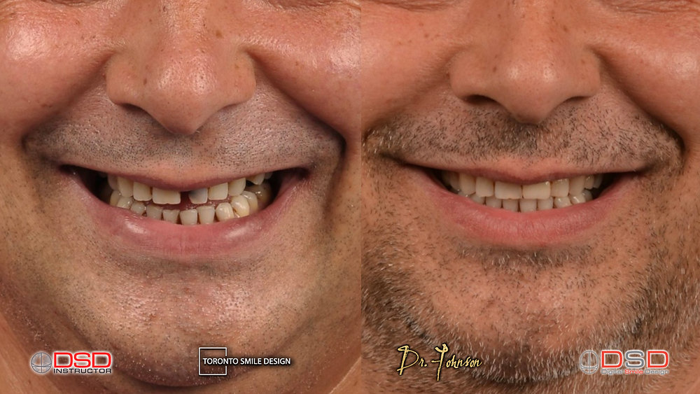 Single Tooth Implants: The Best Solution for Replacing a Missing Tooth?