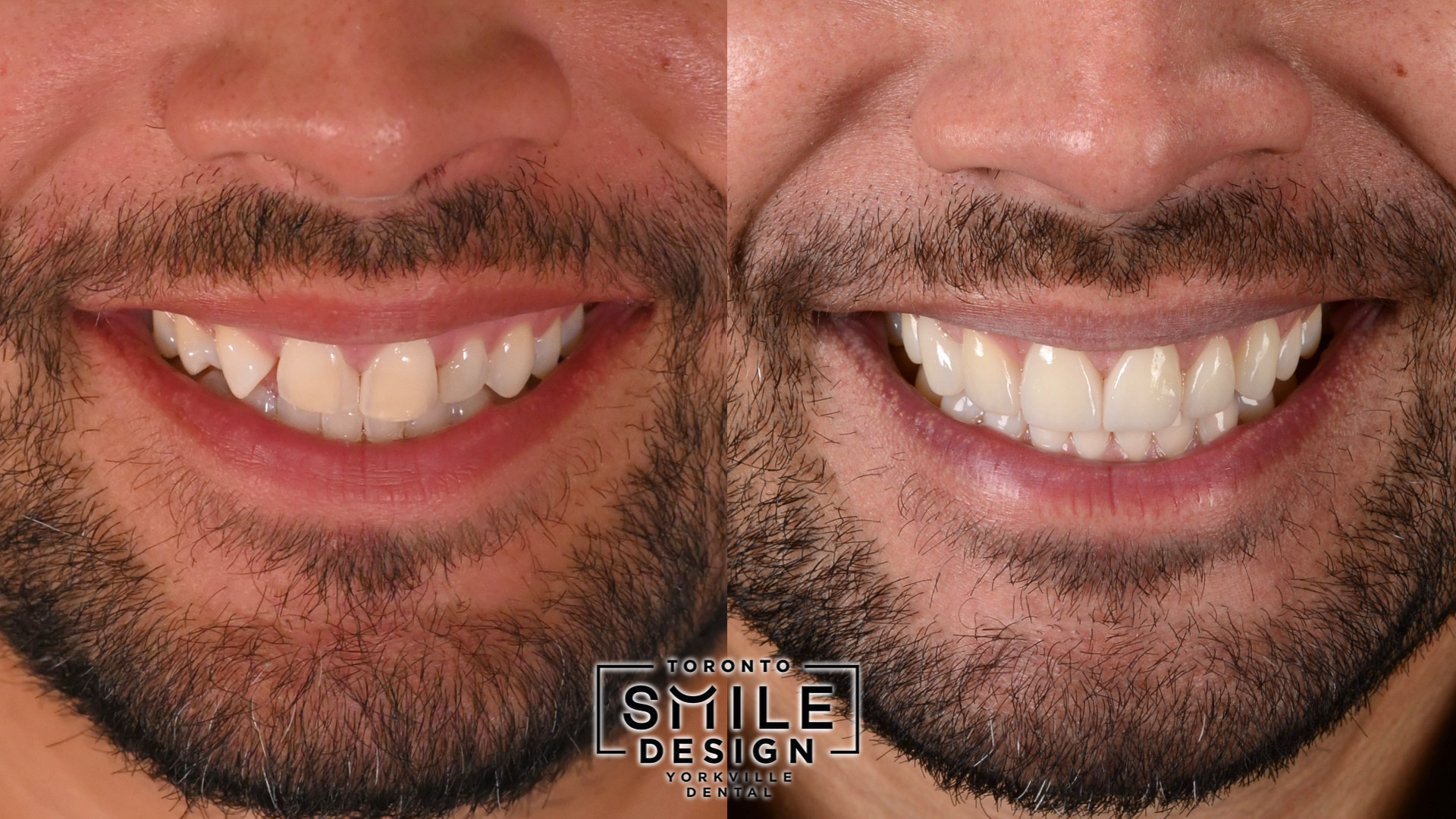 Smile Makeover Missing Lateral Incisor - Dental Veneers