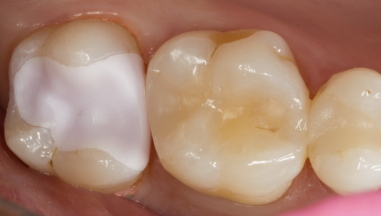 Inlays and Onlays: Minimally Invasive Solution for Heavily Restored Teeth