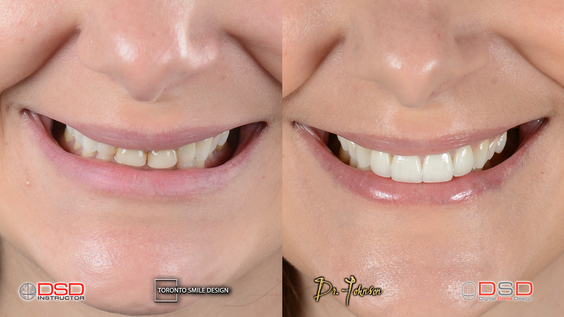 Cosmetic Dentist Toronto Smile Transformation - Smile Makeover Toronto