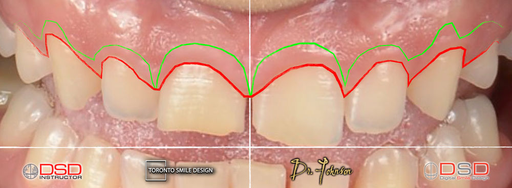 Laser Gum Contouring - Gummy Smile Treatment - Toronto Dentist