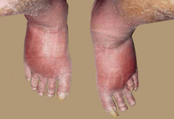 What about Peripheral Neuropathy?