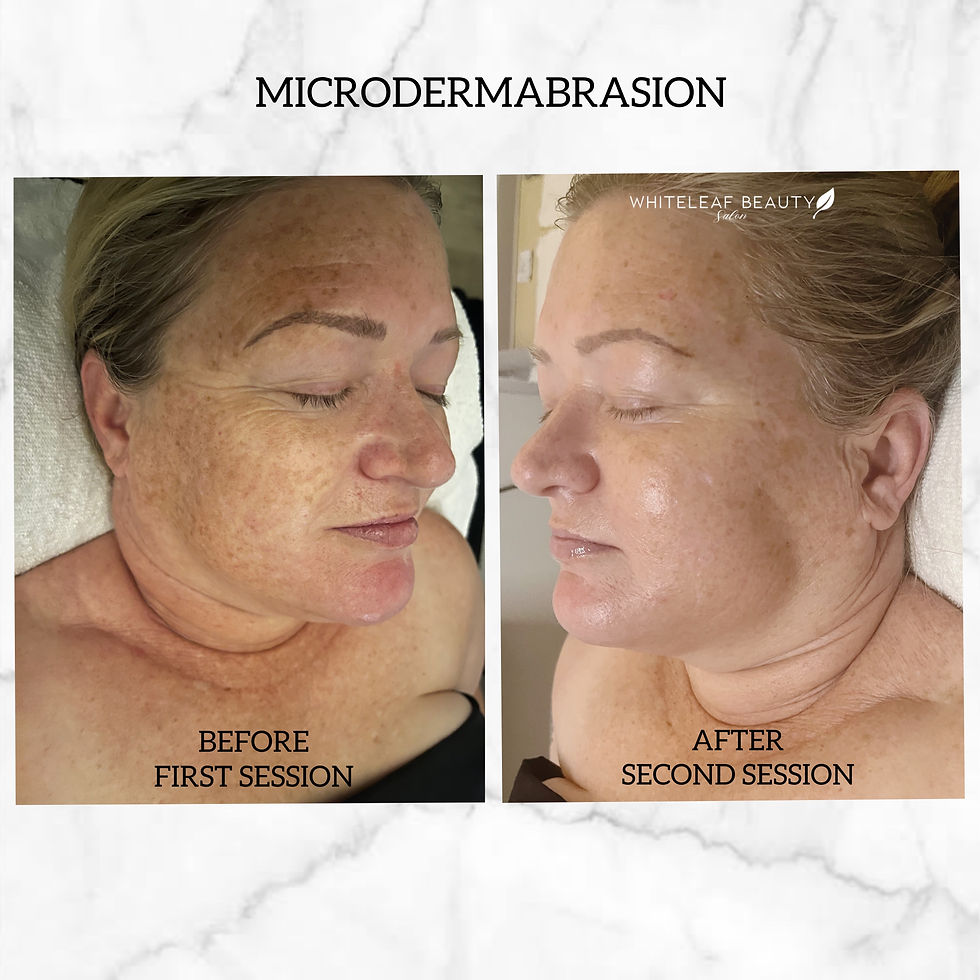 Standard Microdermabrasion | Whiteleaf Beauty