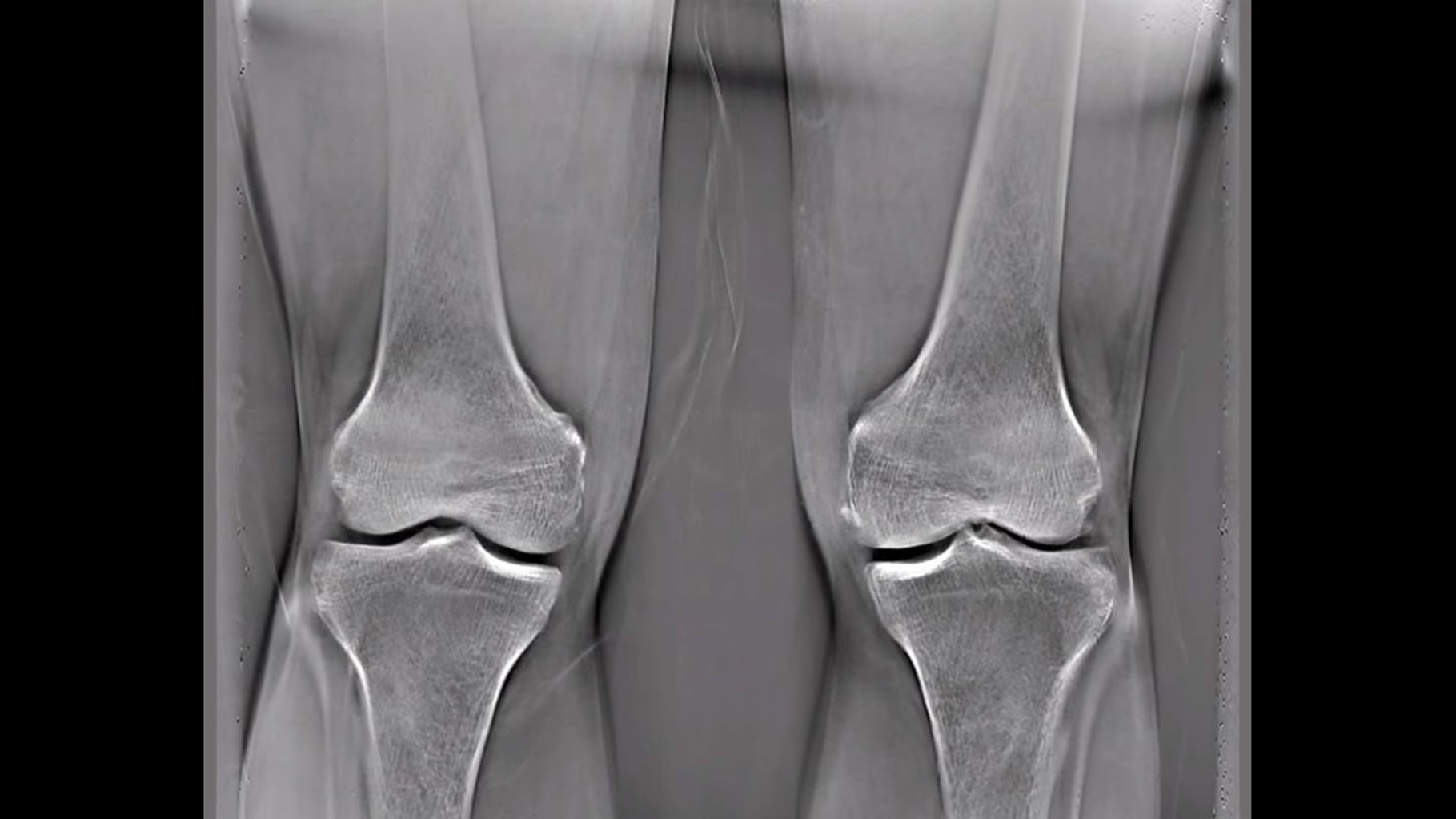 Tomosynthesis | Shimadzu's Advanced Application