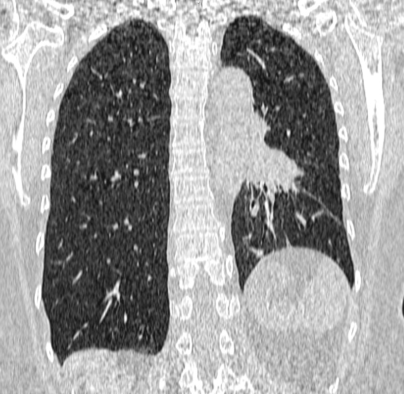 Tumor hiliar pulmonar: Planificación 3D que permitió salvar un lóbulo ...