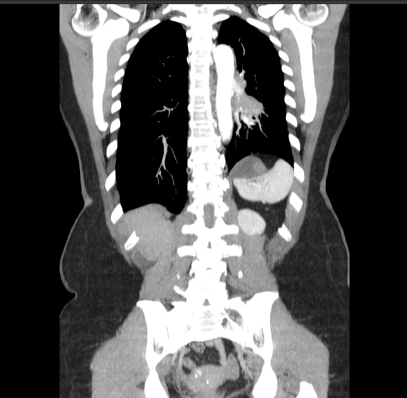 Tumor hiliar pulmonar: Planificación 3D que permitió salvar un lóbulo ...