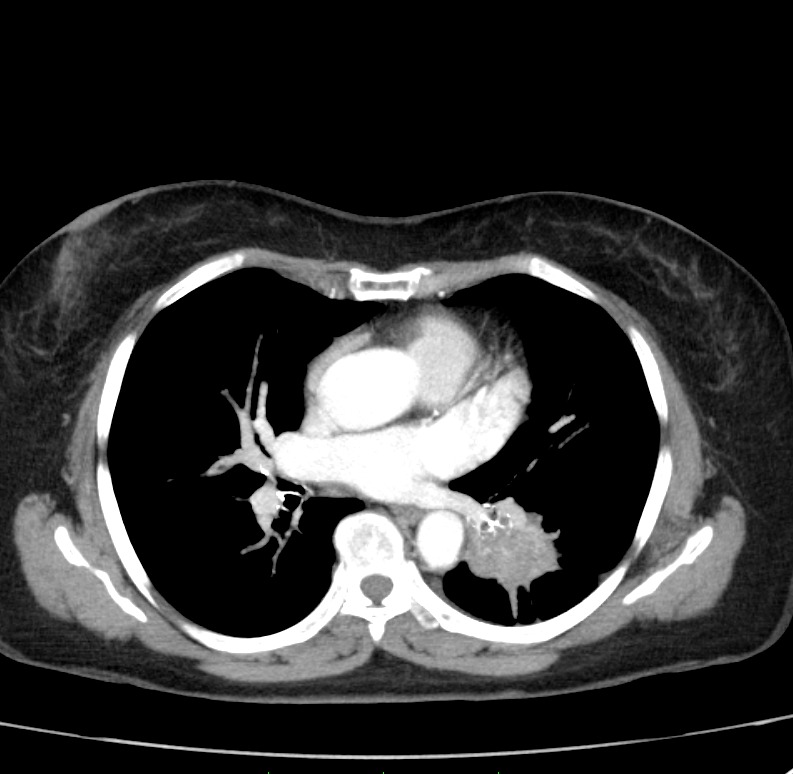 Tumor hiliar pulmonar: Planificación 3D que permitió salvar un lóbulo ...