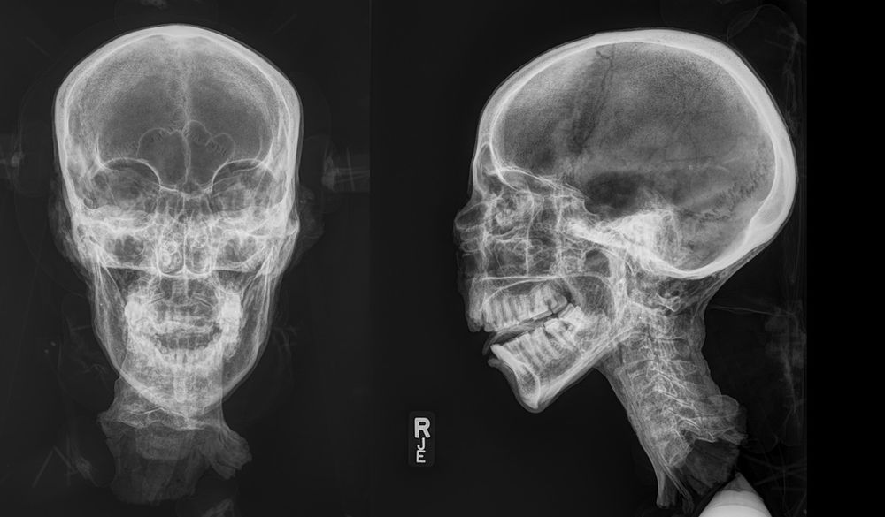 Looking at the mummy x-rays