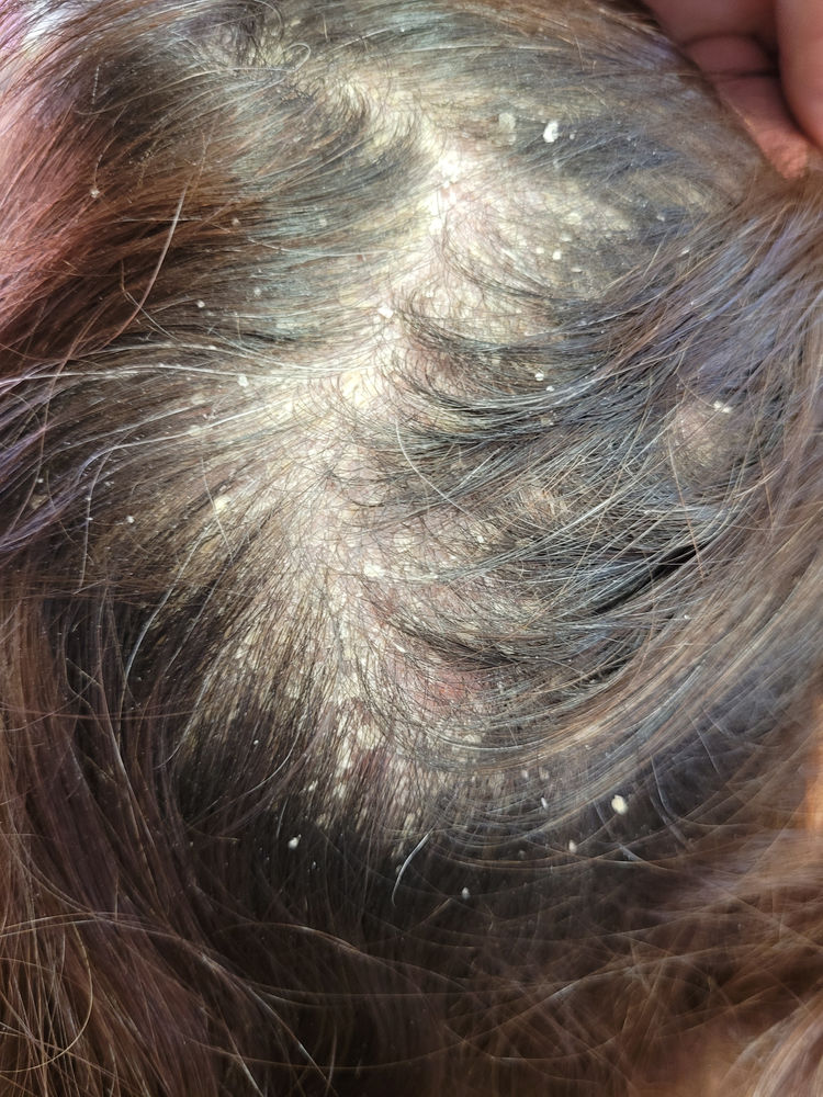 Roos of een droge hoofdhuid: wat is het verschil?