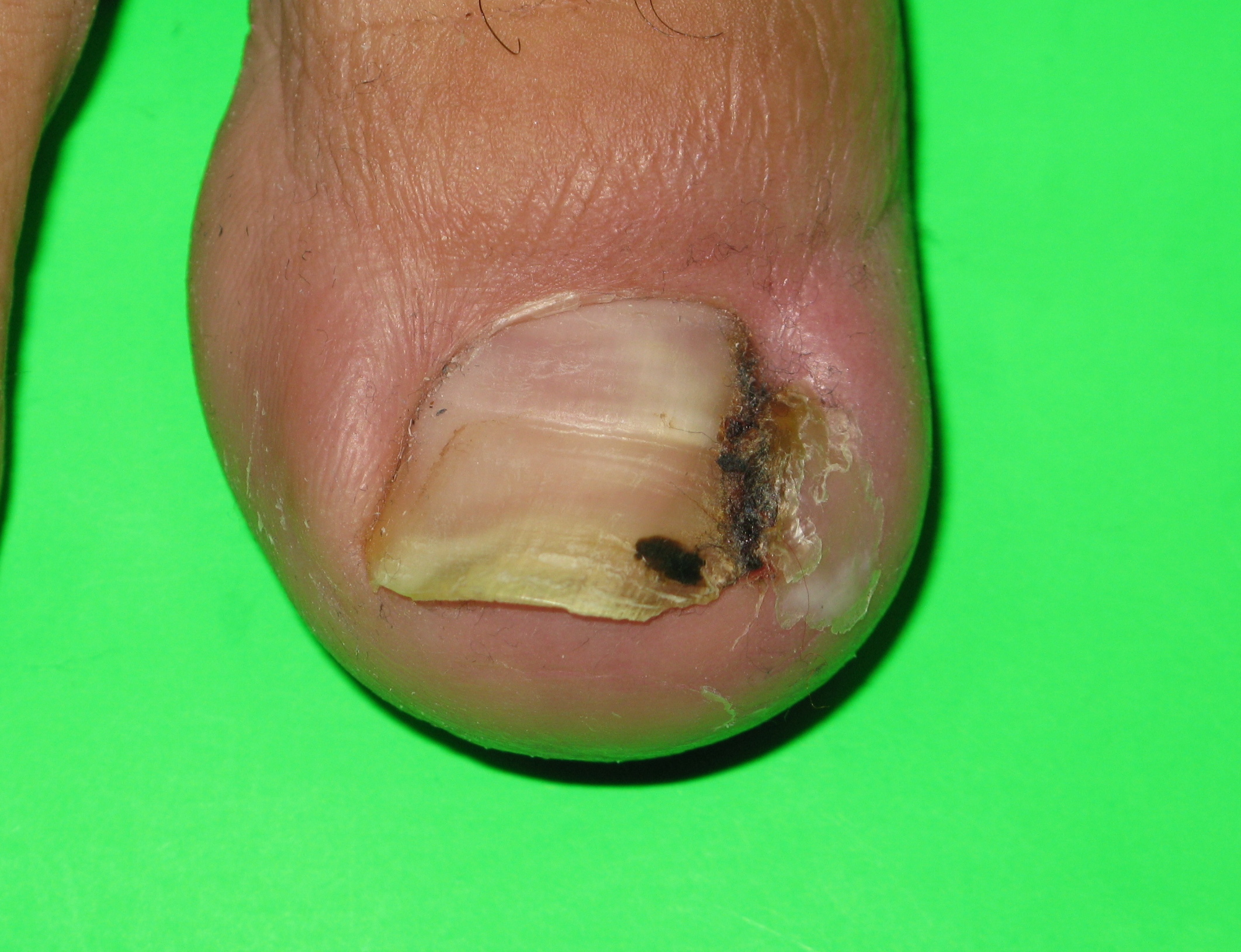 VANDENBOS PHOTOS | overgrown-toeskin