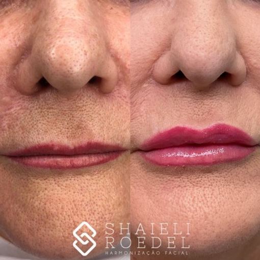 Lábios finos? Revelamos tudo sobre preenchimento labial