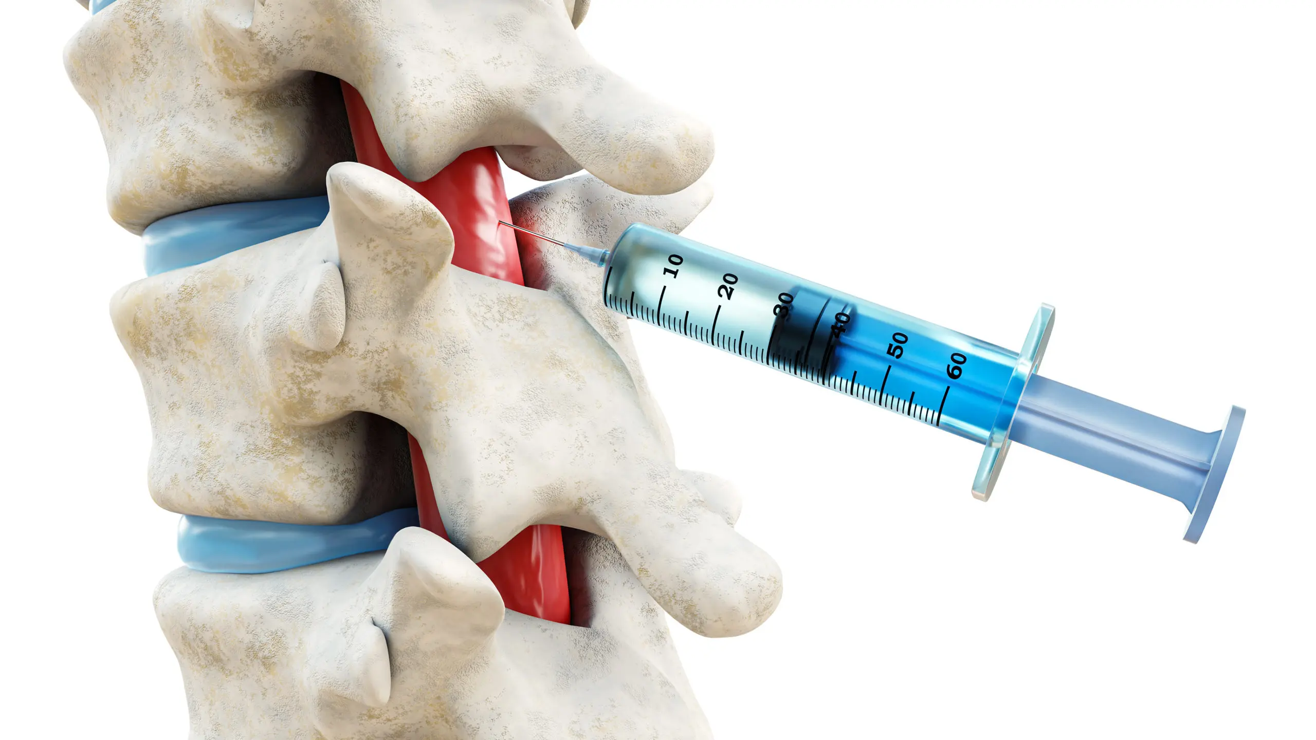 Epidural Injections | Premier