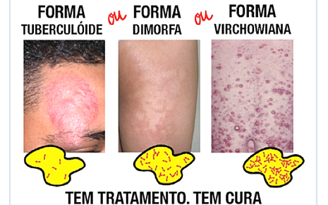 Desvendando a Saúde Pública: Hanseníase