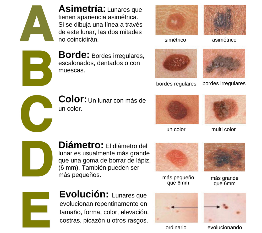 El ABCDE ... DE TUS LUNARES.