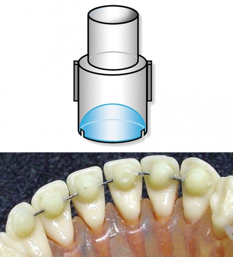 MINI MOULES WIRE BONDER petit | OrthoFlex