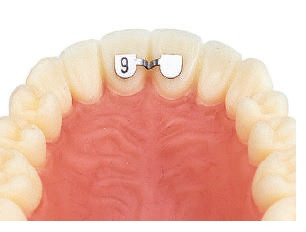 UPPER RETAINER CENTRAL TO CENTRAL | OrthoFlex