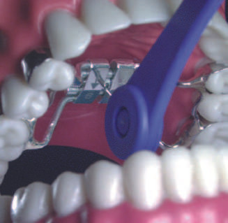 Keys EXPANSION SWIVEL KEY | OrthoFlex