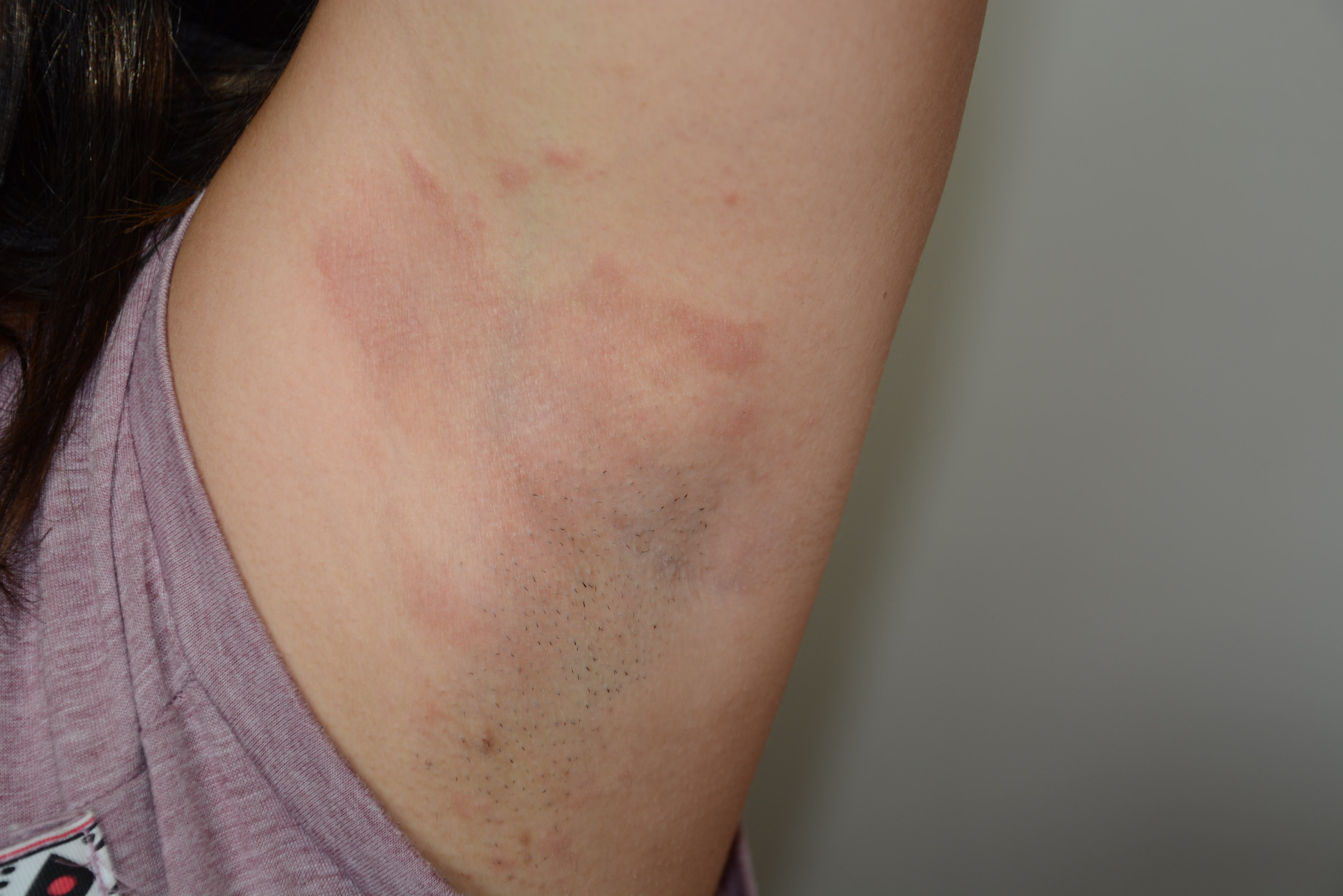 What To Do When Deodorant Causes Rash At Gayla Wilson Blog