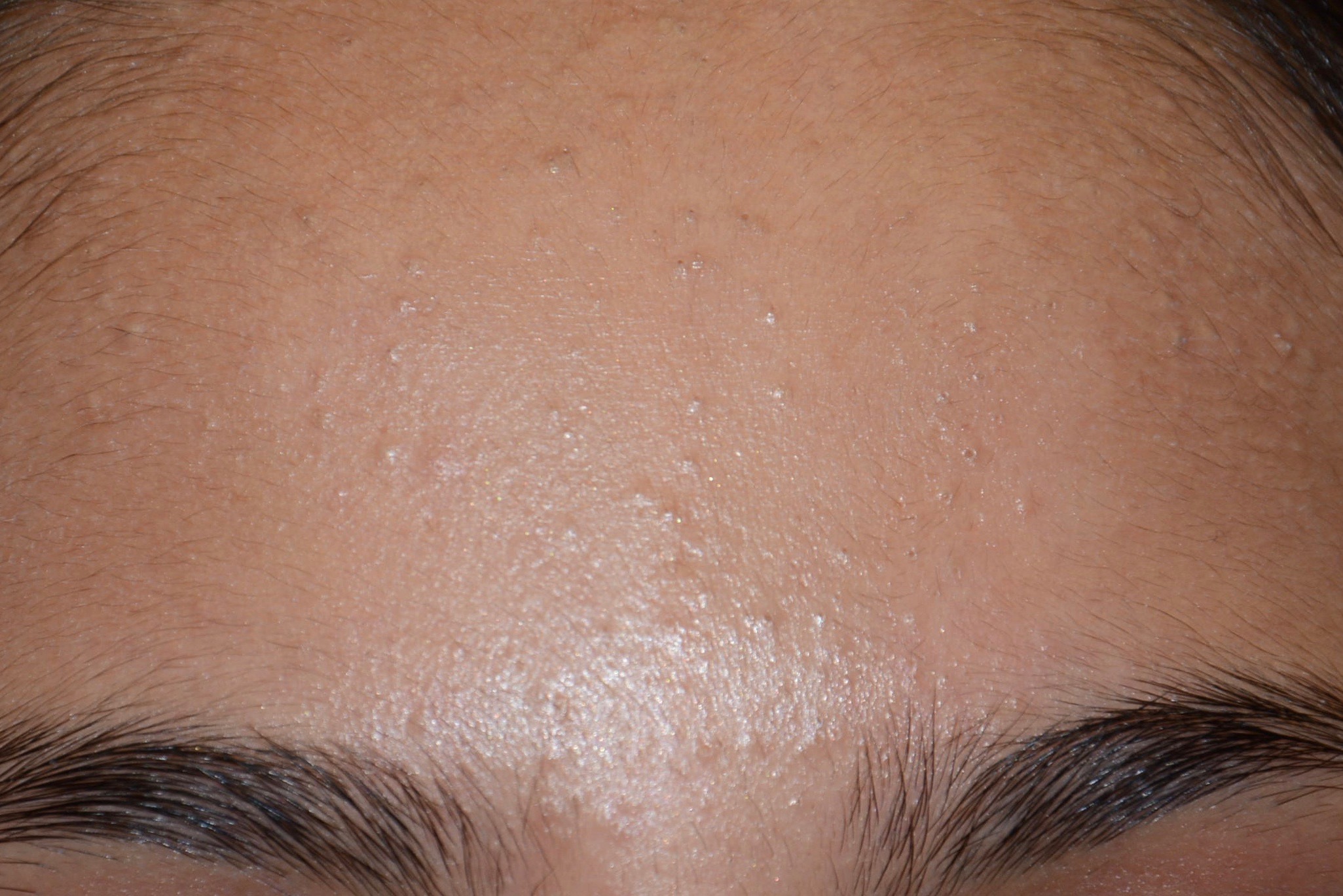 Acne | Dr N Raboobee dermatologist | Westville