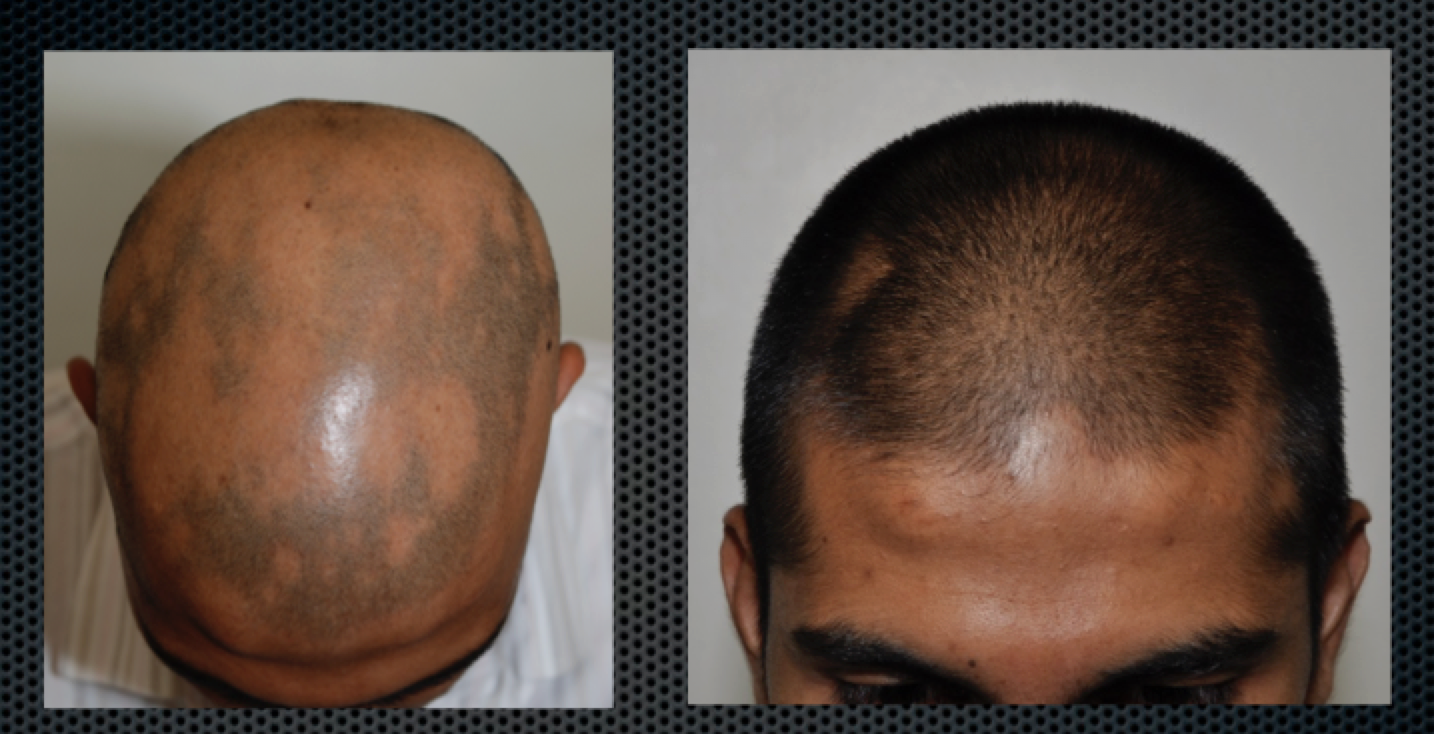 Alopecia areata | Dr N Raboobee dermatologist | Westville